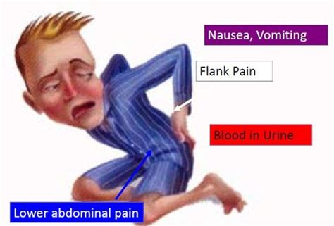 Nephrolithiasis Flashcards Quizlet
