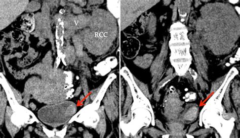 Genitourinary Learning Modules Ct Scanning