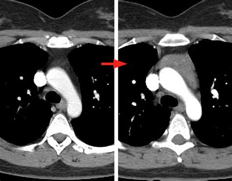 Thymic Lymphoid Hyperplasia Ct At Brendan Gates Blog