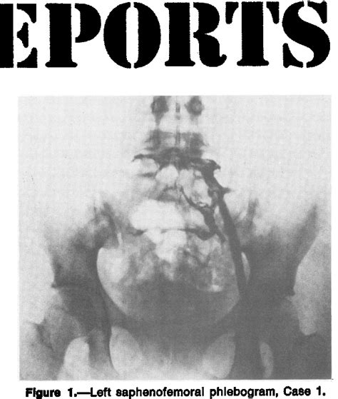 An Anatomical Basis For Unilateral Leg Edema In Adolescent Girls Semantic Scholar