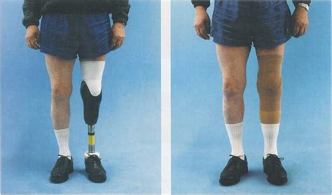 Necrosis Of The Leg Osteonecrosis Avascular Necrosis Symptoms And Causes