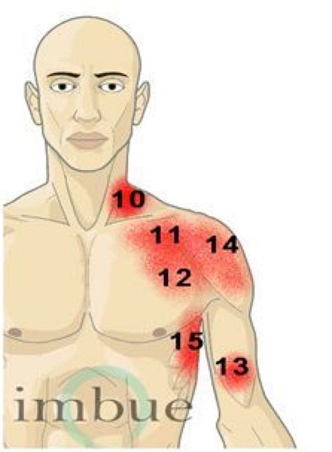 Trigger Point Therapy Treating Pectoralis Major Artofit