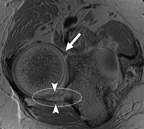 Annular Ligament Of The Elbow Mr Arthrography Appearance With Anatomic