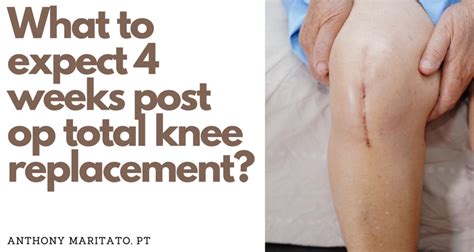 13 Week Recovery Timeline For Knee Replacement Balanced 43 Off