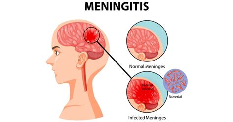 Cryptococcal Meningitis Symptoms Causes And Treatment Apollo Hospitals