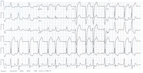 Bundle Branch Block Causes Symptoms Diagnosis And Treatment Natural Health News