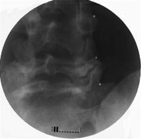 Percutaneous Neural Destructive Techniques Anesthesia Key