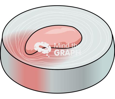 Disc Herniation Degeneration