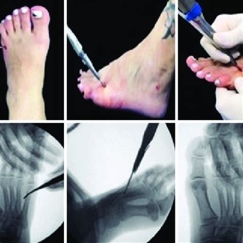 Intraoperative Sequence Of The Surgical Technique A Clinical Image