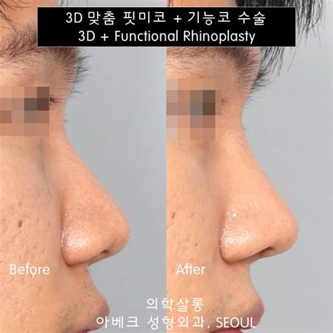 남자 비중격 코성형 비염 수술 및 반듯한 콧대 【dr 아베크 코성형】 네이버 블로그