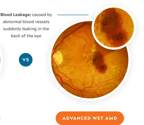 Age Related Macular Degeneration Amd Fact Sheet Vista Center For The Blind And Visually Impaired