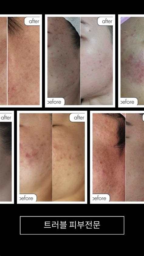 울산 아르케스킨앤바디 울산점💎 🌿 자극은 최소화하고 효과는 극대화 트로이필은 피부 턴오버 주기를 정상화하여 건강한 피부 컨디션을 되찾도록 도와줘요 꾸준히 관리하면