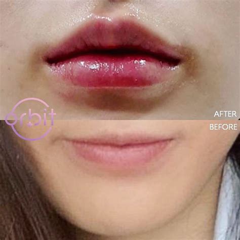 오빗클리닉 ️오빗은 전후사진 보정을 하지 않습니다 ️내돈내산 후기☺️💋💖 필러맛집💋