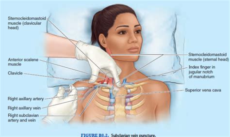 Subclavian Vein Central Line Landmarks