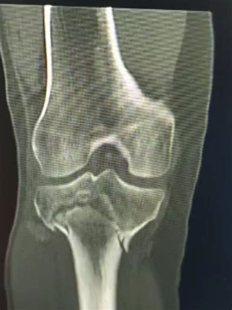 Bicondylar Tibial Plateau Fracture Dr Ahmed Abosalem