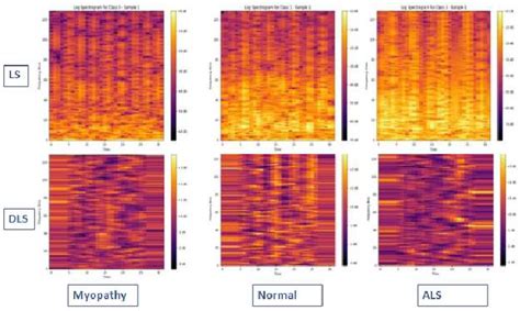 Emg Signal Classification For Neuromuscular Disorders With Attention Enhanced Cnn Paper And