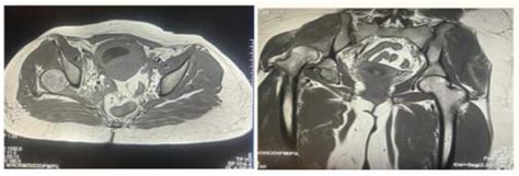 An Atypical Presentation Of Hip Dislocation In A Pregnant Patient A
