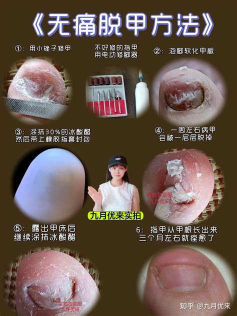 5种灰指甲的封包方法，你用过哪种？别再错误的封包了，分享根治灰指甲的方法，真实案例！ 知乎