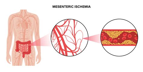Acute Mesenteric Ischemia