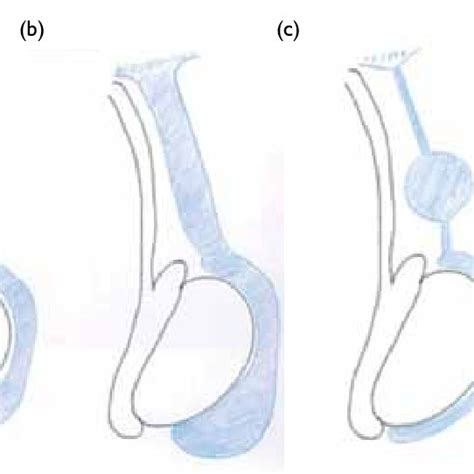 Torsion And Testicular Appendage Torsion Of A Testicular Appendix