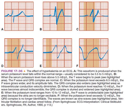 Путь персонального роста Hyperkalemia And Ecg
