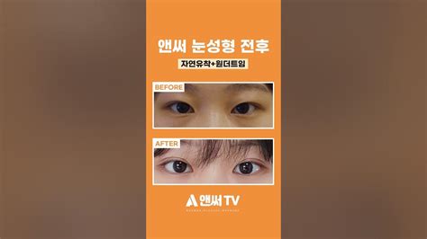 앤써성형외과 눈성형전후 Shorts Youtube