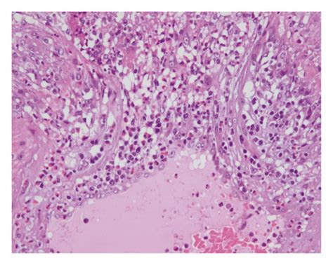 The Histopathological Examination Of The Gallbladder It Reveals A Download Scientific Diagram