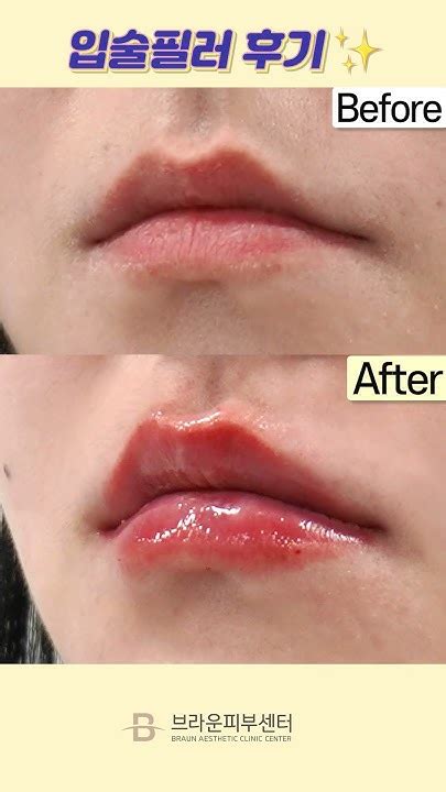 👉입술필러 전 필수 시청👄👈 Shorts 입술필러 입술필러후기 필러 시술후기 피부과추천 Kbeauty 전후사진 필러시술 필러후기 강남피부과 Youtube