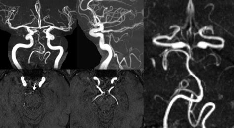 Posterior Cerebral Artery
