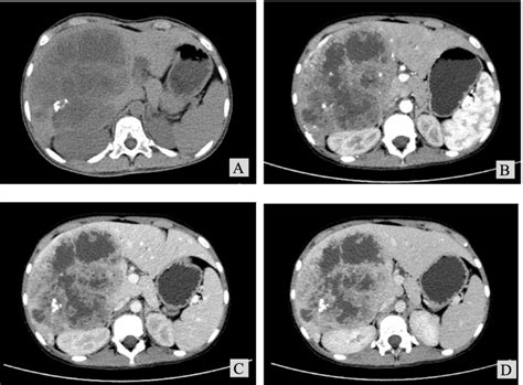 Preoperative Ct 1a Plain Ct Scan Shows A Large Mass In The Right Lobe