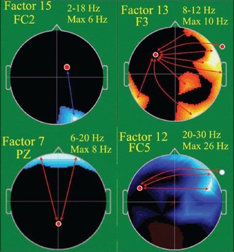Eeg Spectral Coherence Factors At School Age Control C N 8
