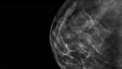 Using Deep Learning For Mammography Assessment By Nyu Center For Data Science Center For