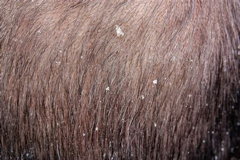 Reasons For Your Itchy Scalp Besides Head Lice Reader S Digest
