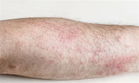 Краснуха симптомы причины и лечение у взрослых и детей диагностика и профилактика