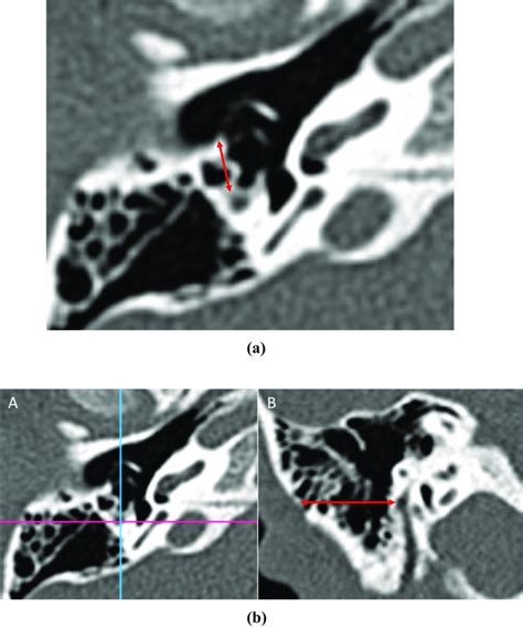 Morphometric Analysis Of Temporal Bone Radiology For Cochlear Implant Candidacy Pmc