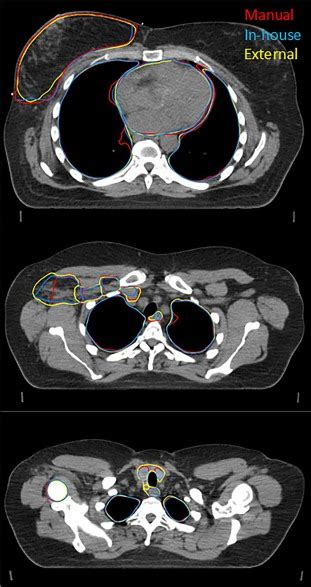 Comparison Of The Output Of A Deep Learning Segmentation Model For Locoregional Breast Cancer