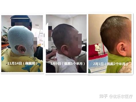 头颅畸形斜头畸形特征 知乎