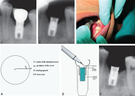 how to remove implant abutment screw yagu dental