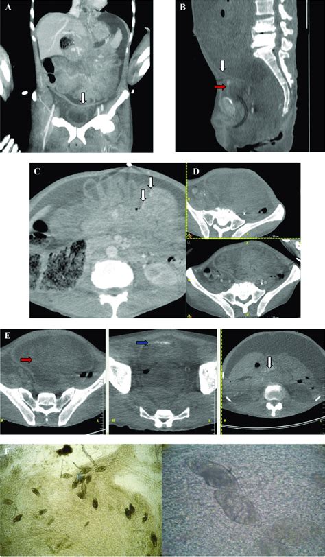 Abdominal Ct Scan And Rectosigmoid Biopsy Specimen Images A Maximum Download Scientific