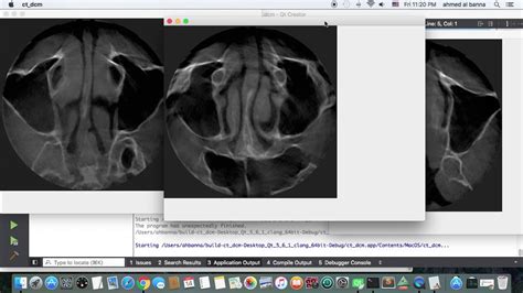 Dcm Dicom Images Qt Opencv Gsdcm Youtube