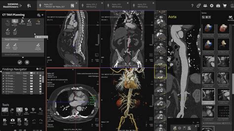 Demo Worlds First Photon Counting Ct