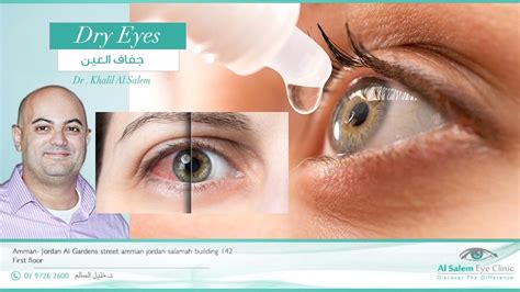 جفاف العين و إلتهاب الجفون أد خليل السالم