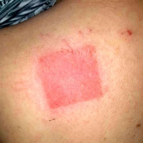 Mild Contact Dermatitis