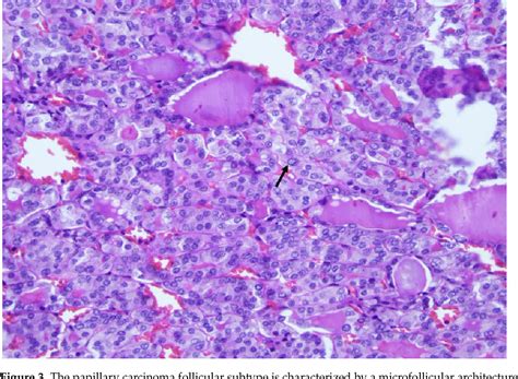 Figure 3 From Cytology And Histology Of Thyroid Nodules Exploring Novel Insights In The