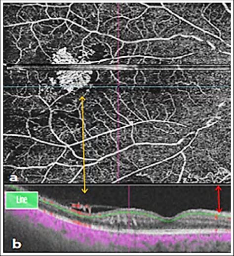 Retinal New Vessels And Intra Retinal Microvascular Abnormalities A Download Scientific