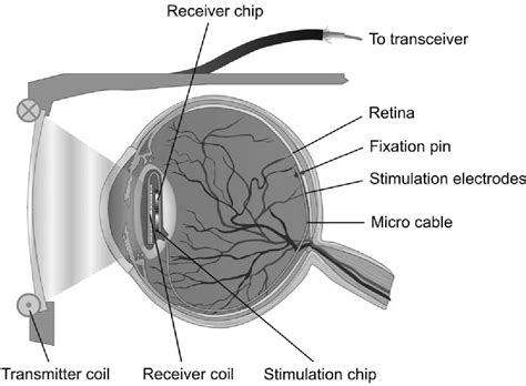 Figure 1 From A Fully Implantable Epiretinal Vision Prosthesis For