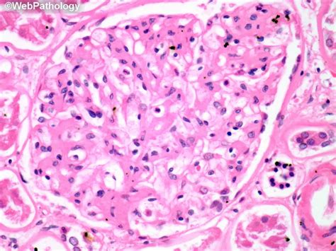 Diabetic Nephropathy Microscopic