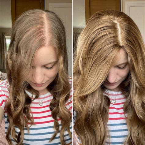 Androgenic Hair