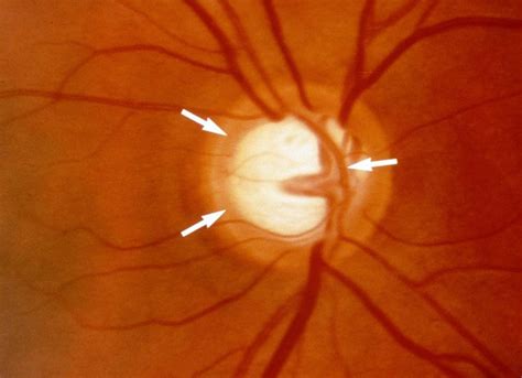 Diagnosing Glaucoma Testing For Glaucoma