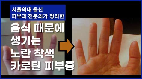 얼굴 손바닥 발바닥이 노랗게 변하는 카로틴 피부증 Youtube